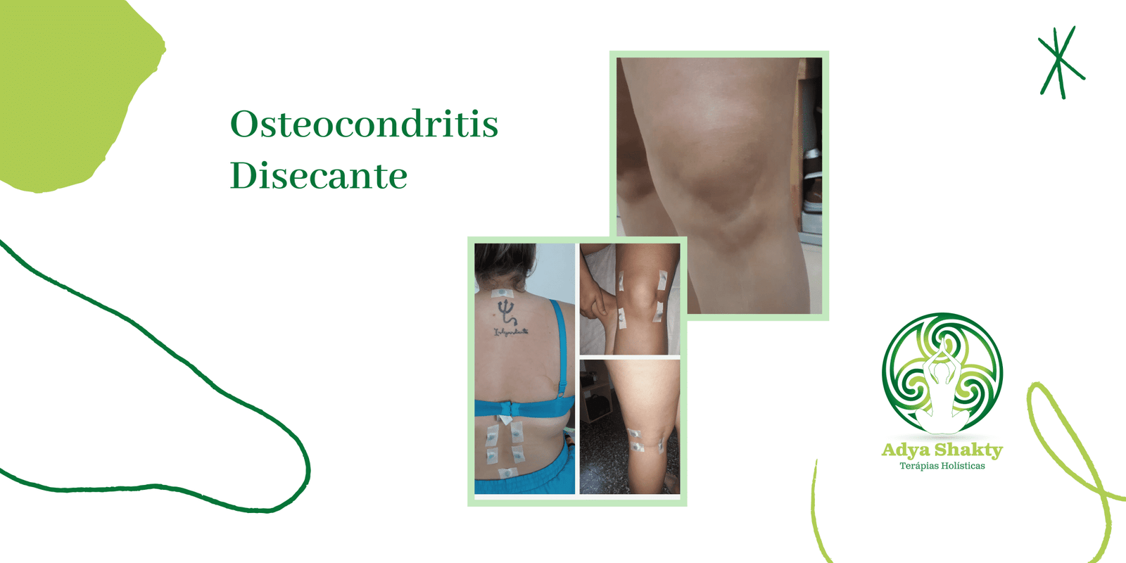 Tratamiento en Paciente con Osteocodritis Disecante - ADYA SHAKTY